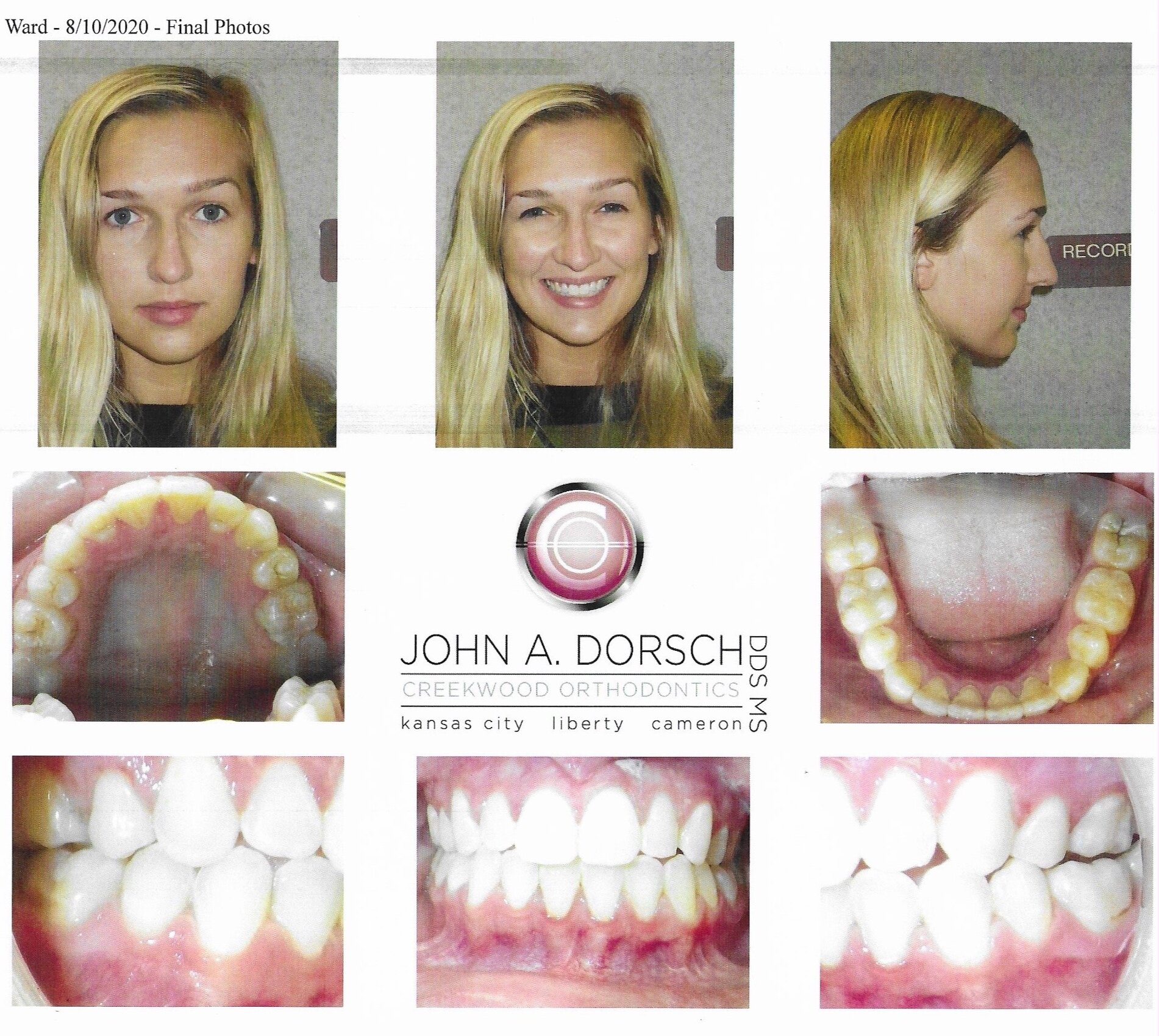 Invisalign: Here's What You Need To Know - Hayden Ward